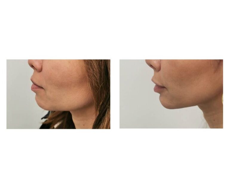 Kinnimplantate Wangenimplantate Zürich - DesthetiX.com